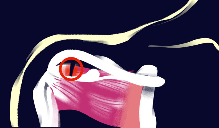 How Do You Treat Rotator-Cuff Tears? - Alumni Association of the ...